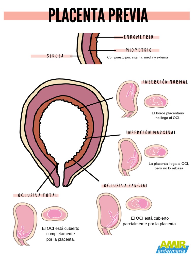 Placenta Previa | PDF