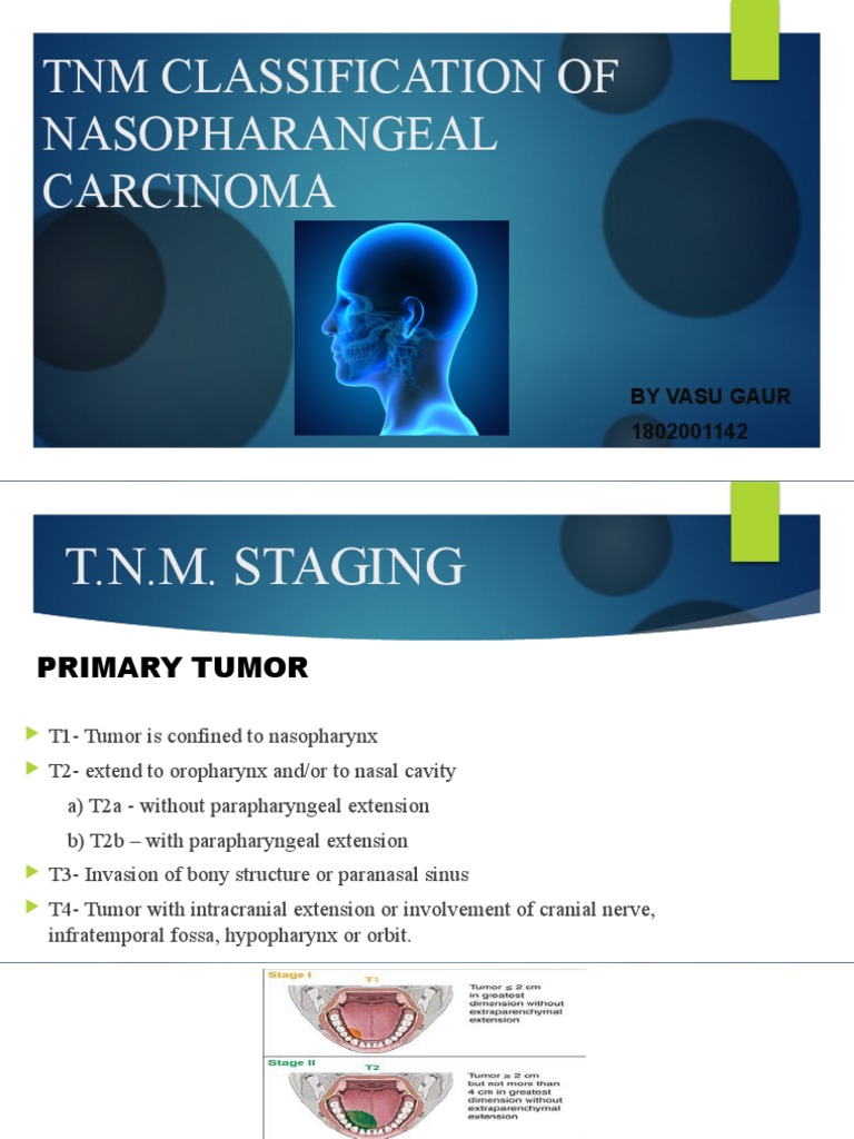 TNM Staging of Nasopharyngeal Carcinoma | PDF
