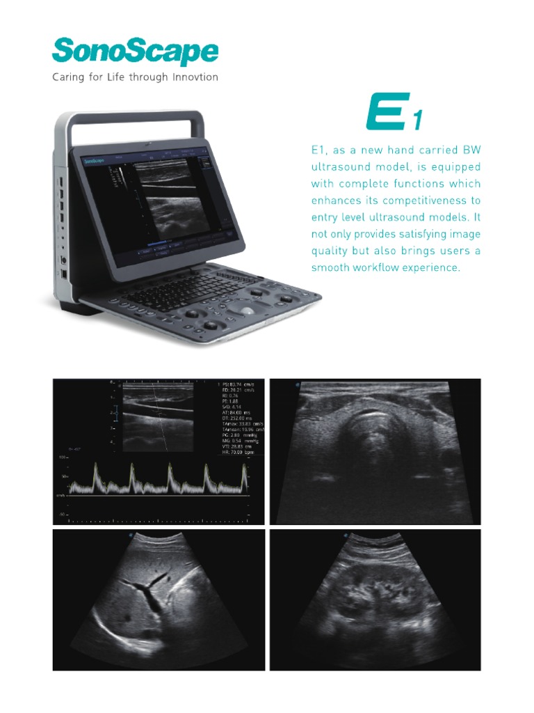 E1 Ultrasound Brochure Sonoscape | PDF E1 Ultrasound Brochure Sonoscape | PDF