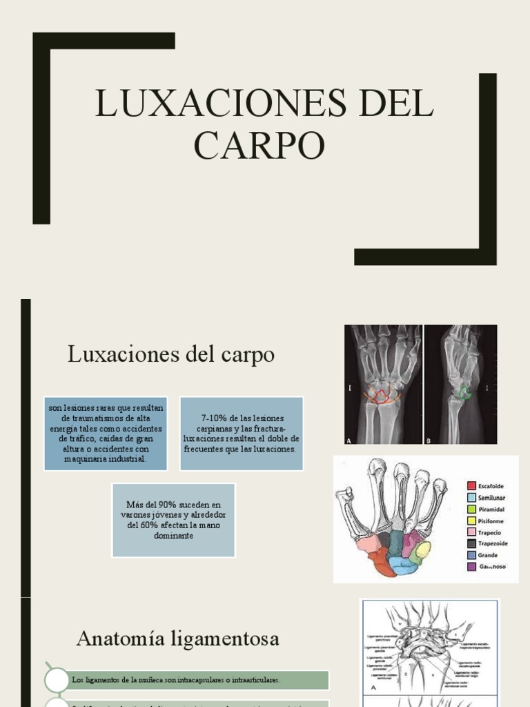 Luxaciones Del Carpo | PDF | Mano | Extremidades (anatomía)