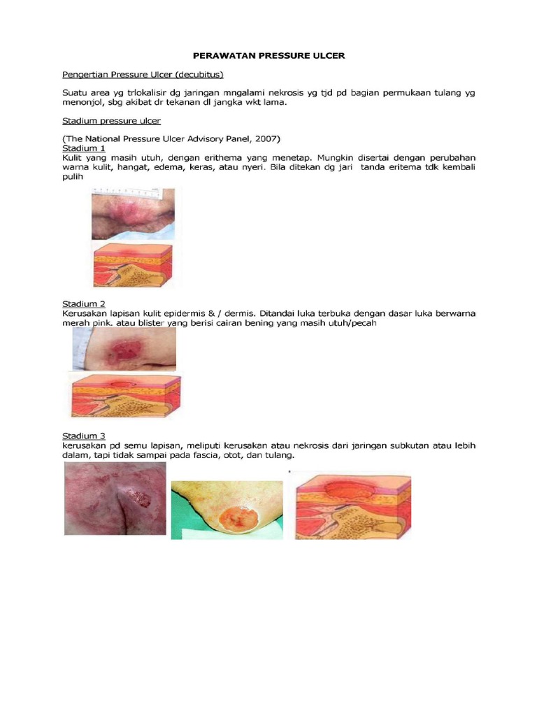 Perawatan Luka Dekubitus | PDF