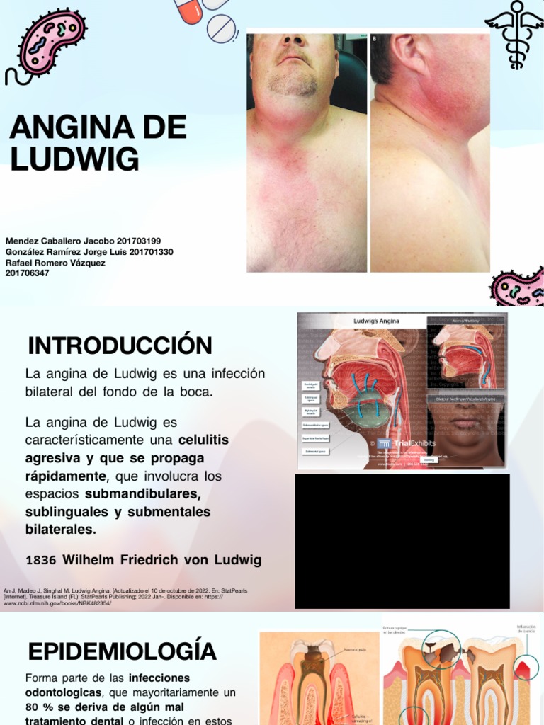 Angina de Ludwig: síntomas y tratamiento | PDF | Especialidades Medicas ...