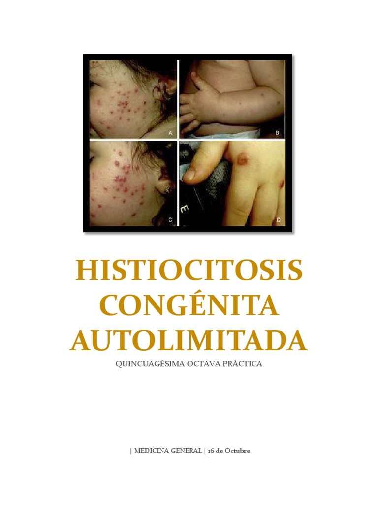 HISTIOCITOSIS CONGÉNITA - Práctica 58 | PDF | Hueso | Trasplante de ...