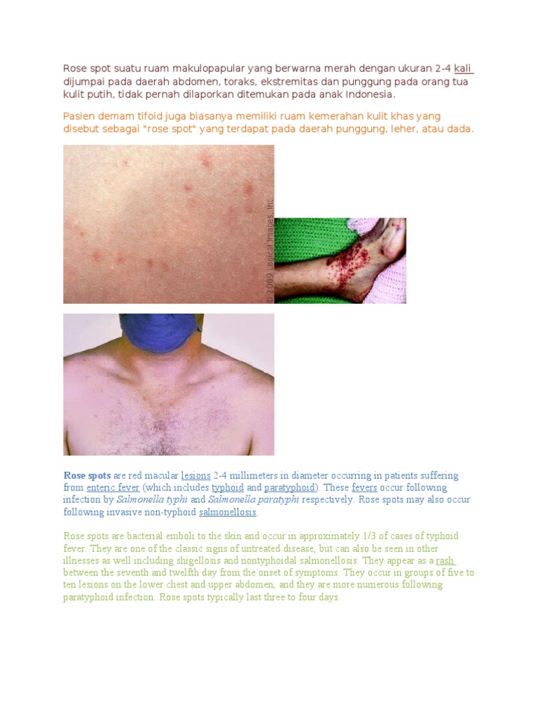 Salmonella Typhi Rose Spots