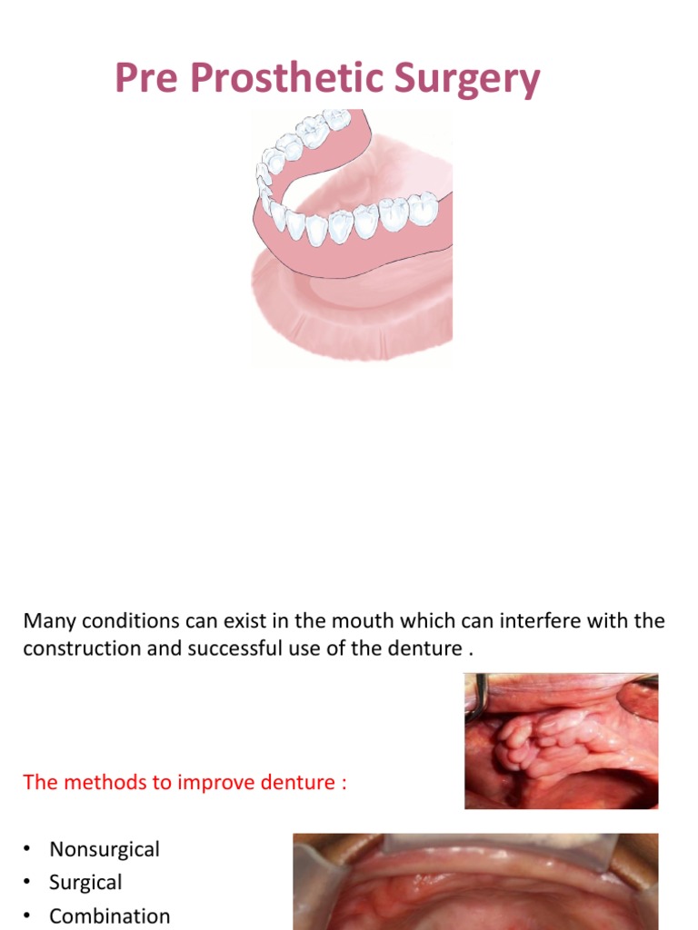 Pre-Prosthetic Surgical Techniques for Improving Denture Outcomes | PDF ...