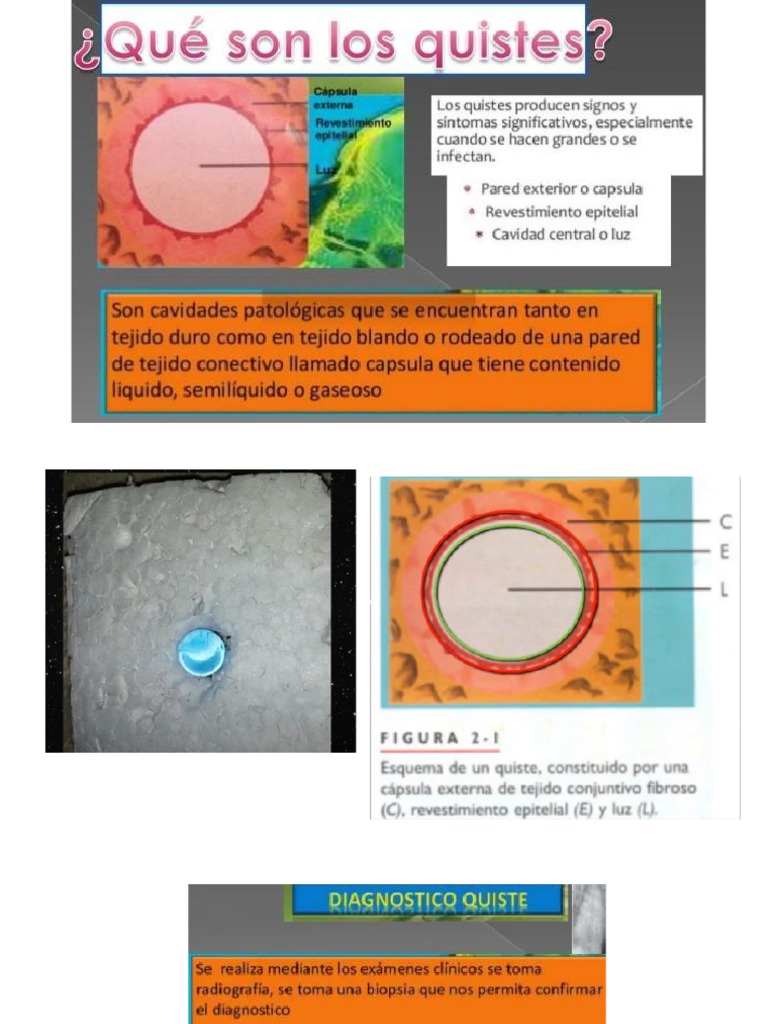 Unidad 6 Quistes | PDF