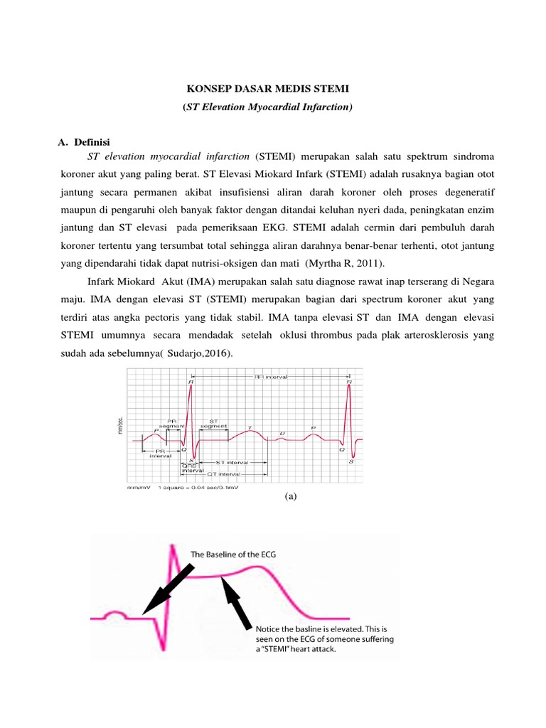 Laporan Pendahuluan STEMI | PDF