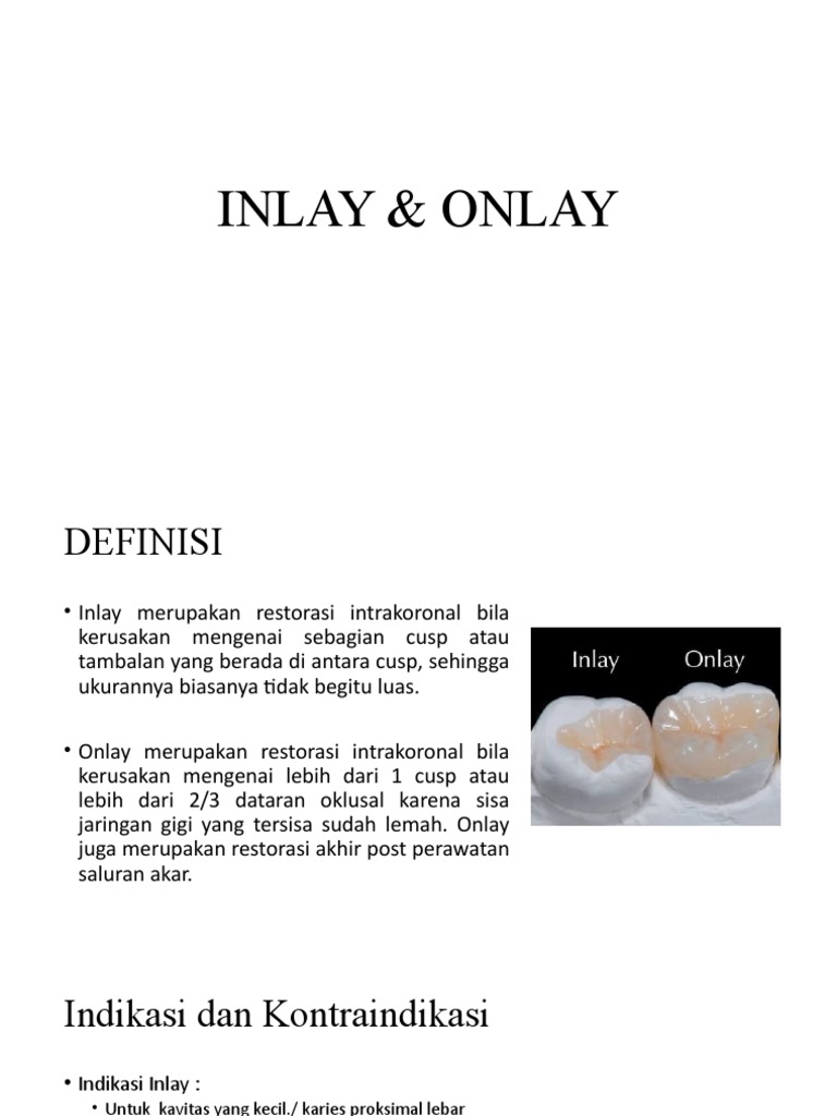 Inlay Dan Onlay | PDF