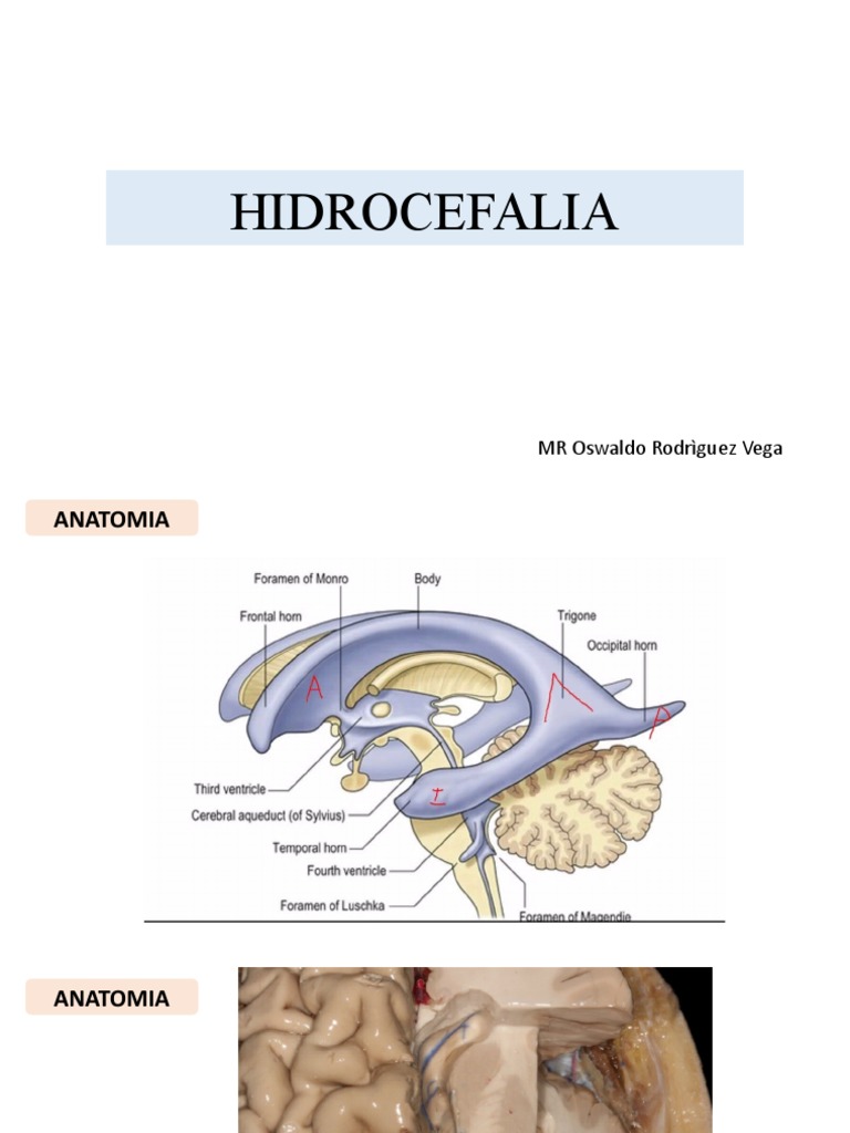 Hidrocefalia | PDF
