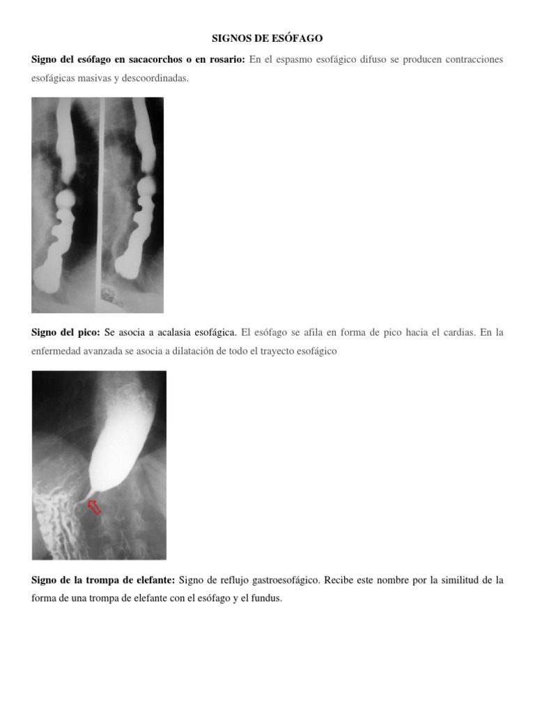 Signos de Esófago y Ulceras | PDF