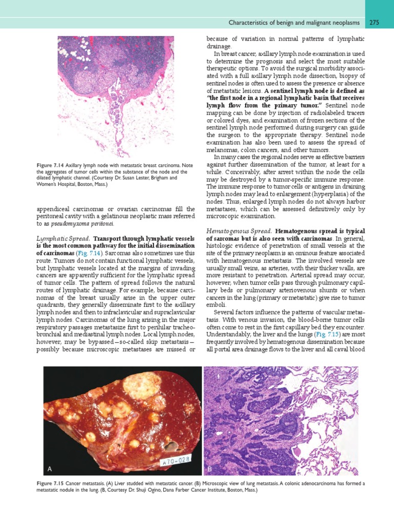 Hematogenous Spread. Lymphatic Spread.: 275 Characteristics of Benign ...