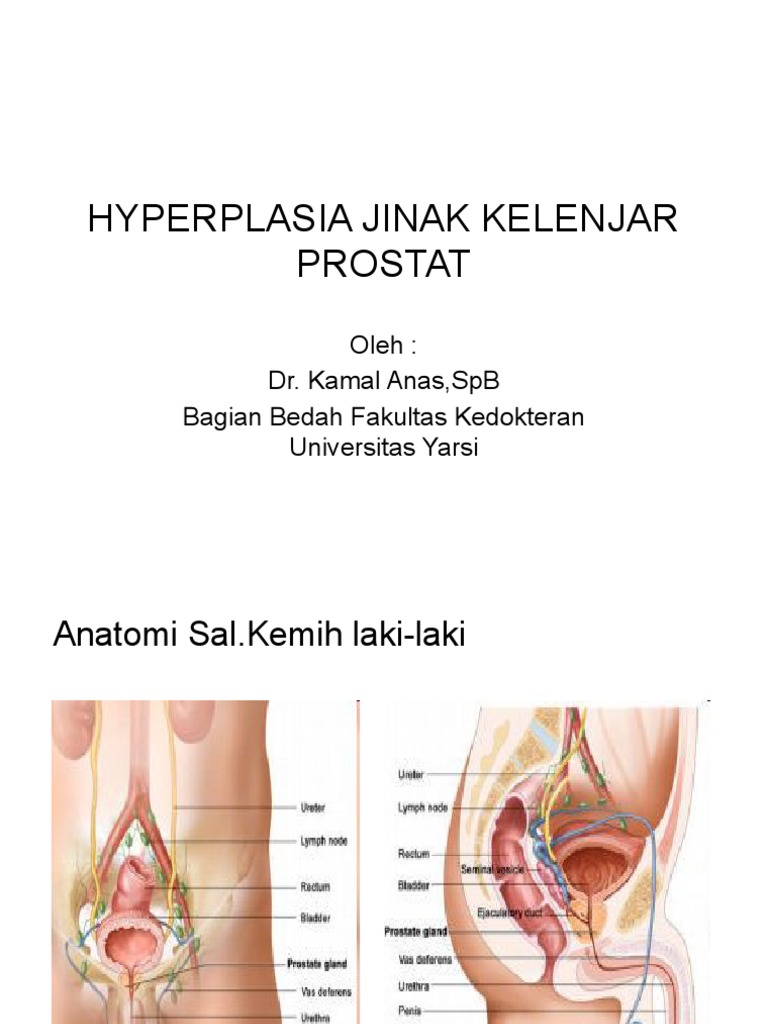 Hyperplasia Jinak Kelenjar Prostat | PDF