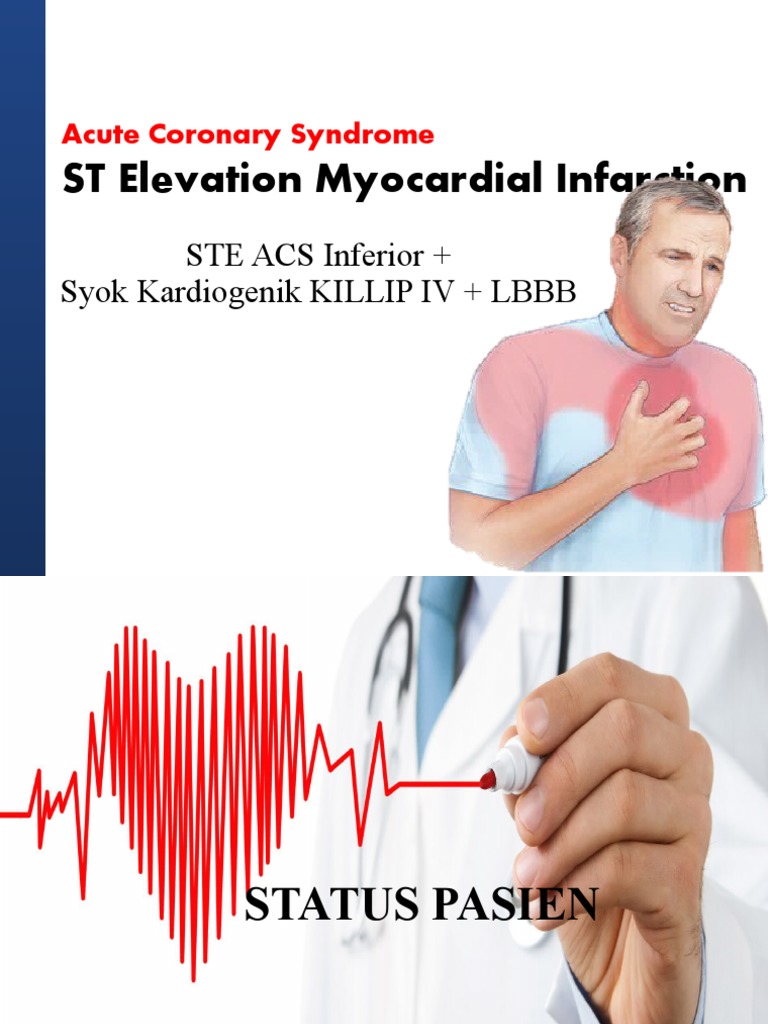 Stemi Inferior LBBB Acute Coronary Syndrome | PDF