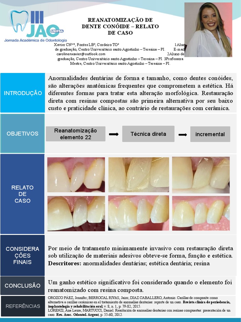 Reanatomização de Dente Conóide | PDF