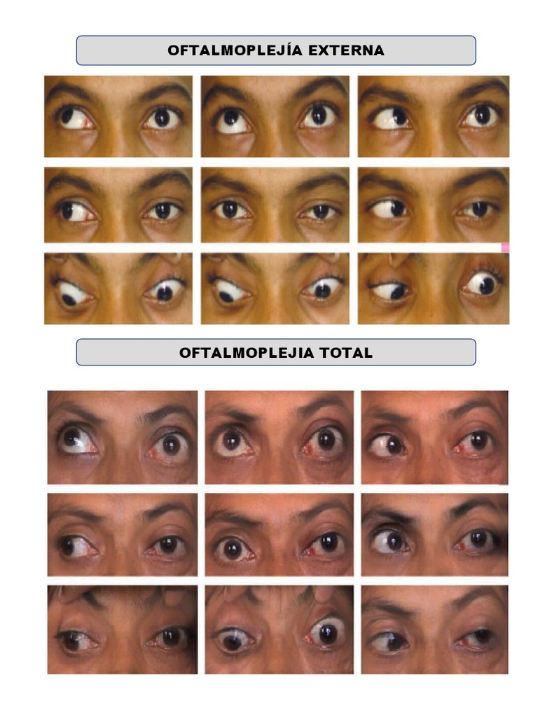 Oftalmoplejia Imagenes | PDF