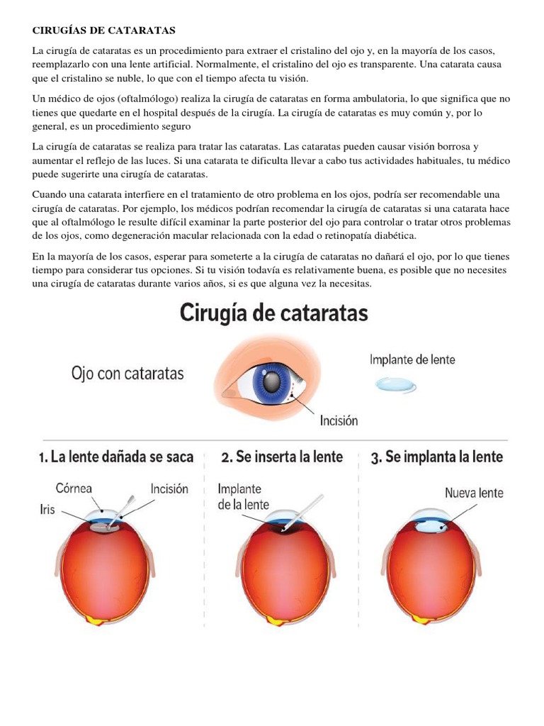 Cirugías de Cataratas | PDF | Catarata | Miopía