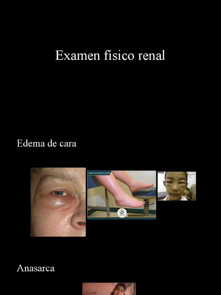 Examen físico renal completo: signos y síntomas clave | PDF