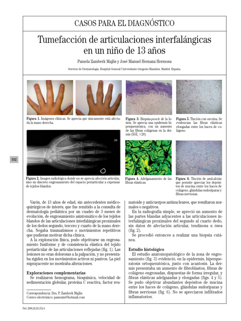 Tumefacción de Articulaciones Interfalángicas | PDF | Medicina CLINICA ...