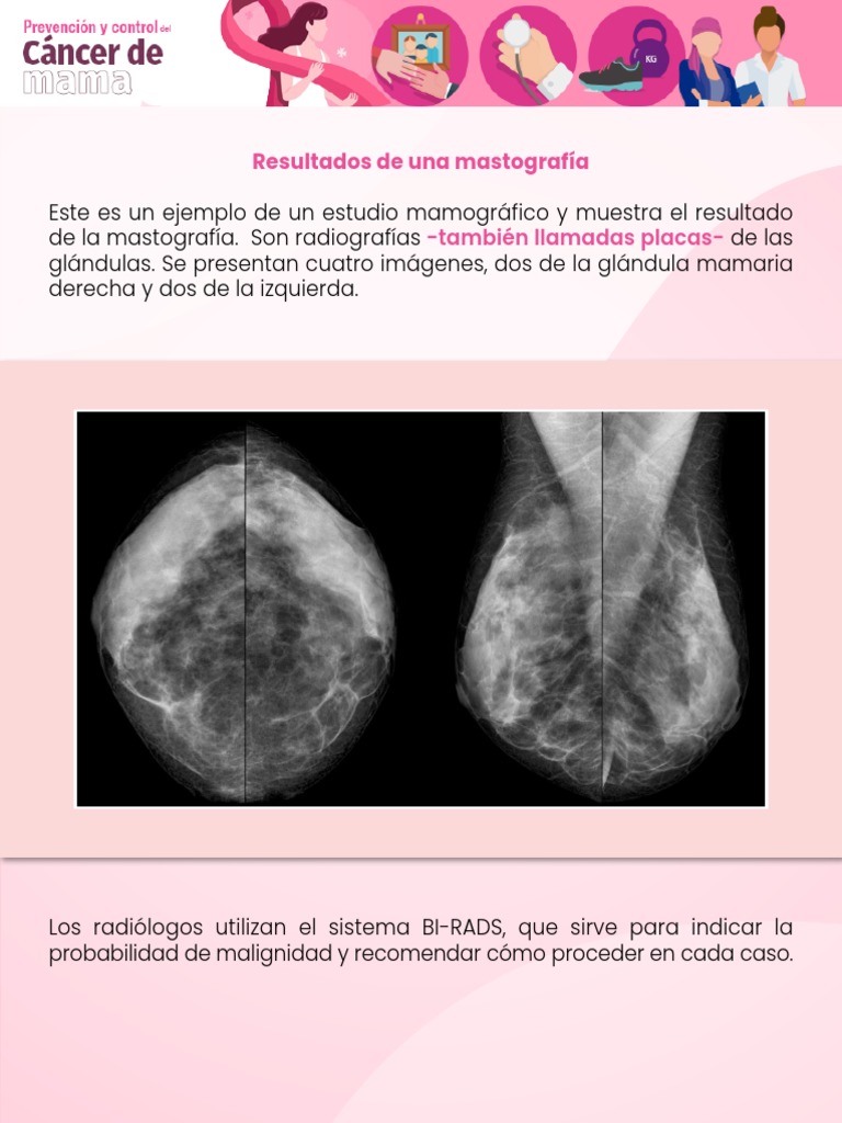 Resultados Mastografía | PDF | Cáncer | Radiología