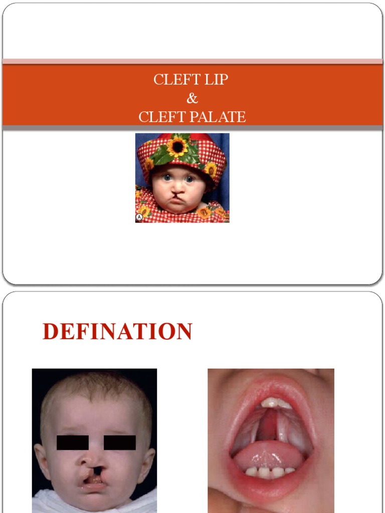 Understanding Cleft Lip and Palate | PDF | Medical Specialties | Facial ...
