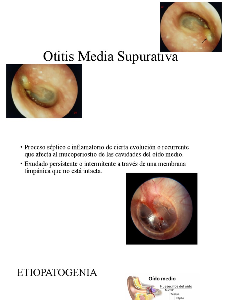 Otitis Media Crónica | PDF | Oído | Cabeza y cuello humanos