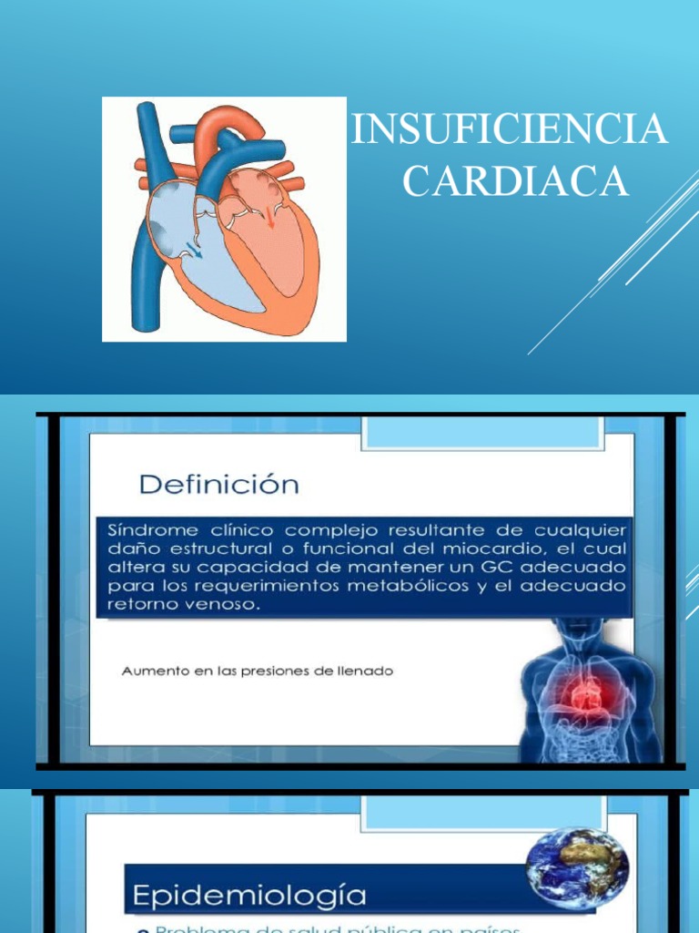 Exposicion Insuficiencia Cardiaca | PDF