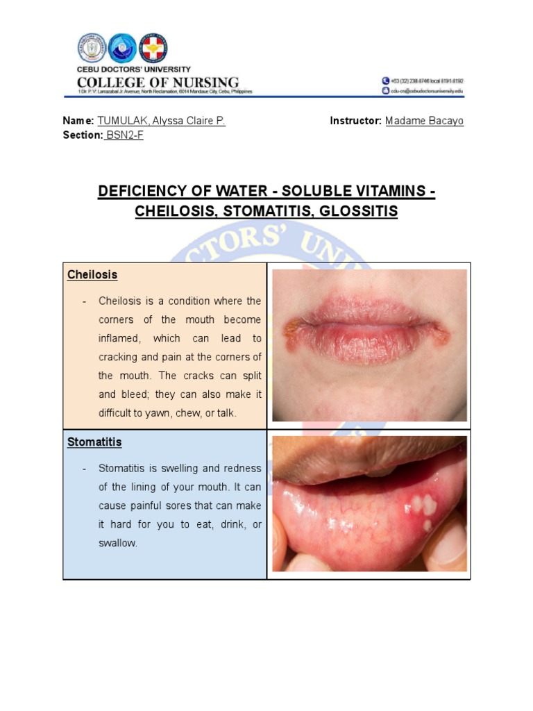 Defficiency of Water - Soluble Vitamins - Cheilosis, Stomatitis ...
