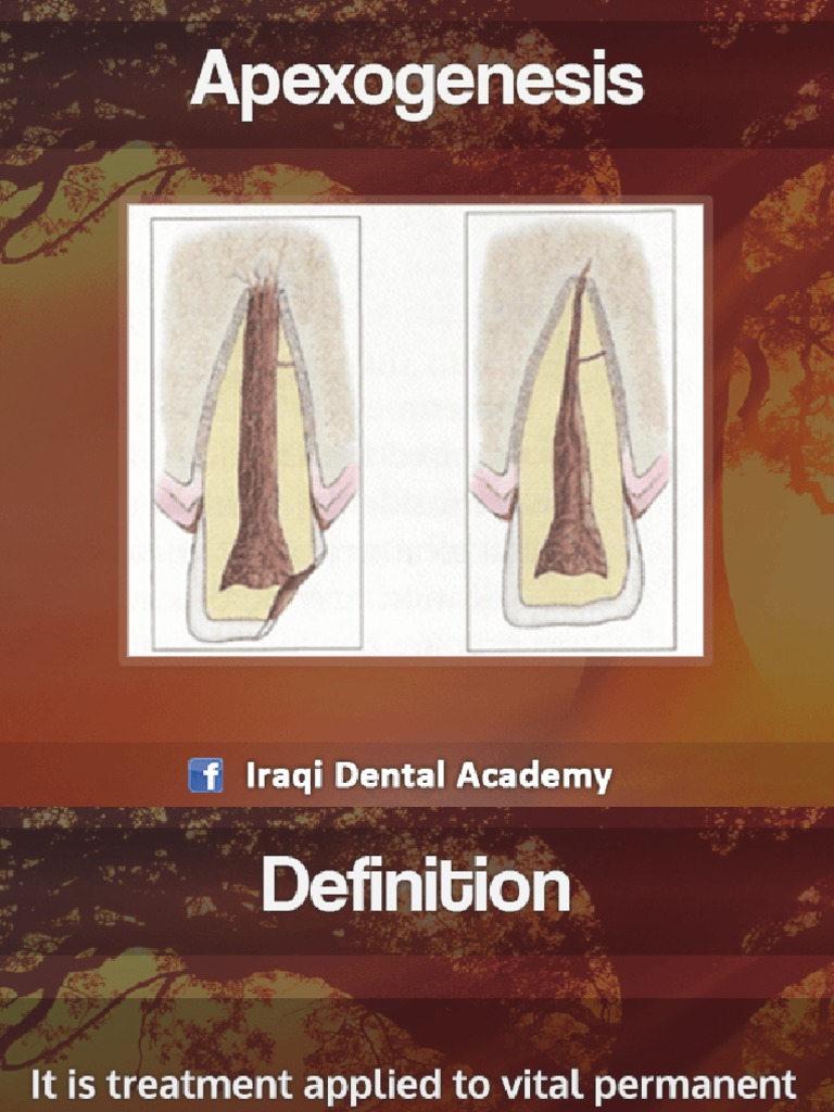 Apexogenesis Procedure | PDF