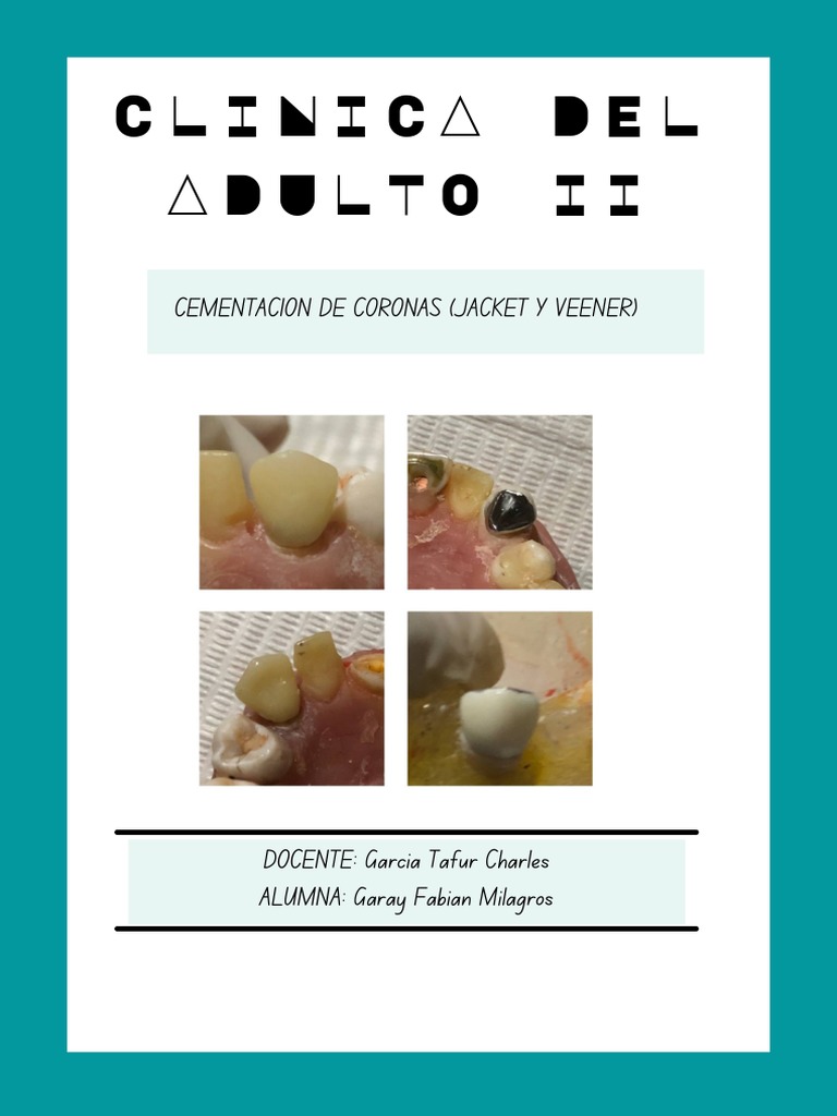 8 Cementación de Coronas | PDF