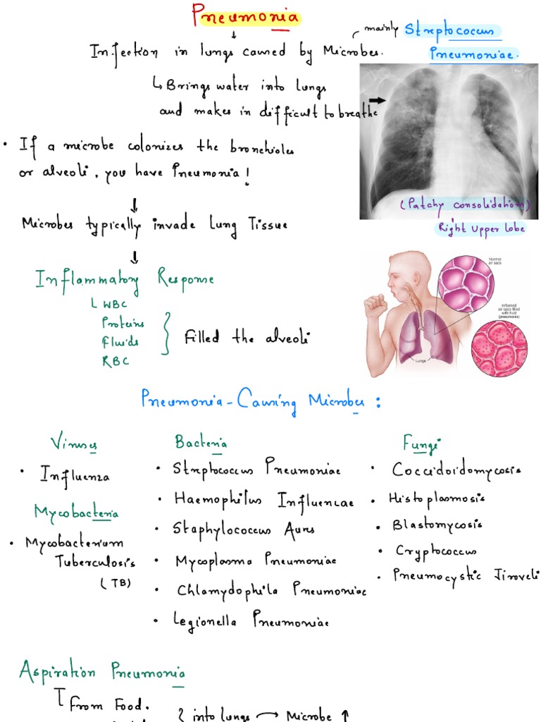 Pneumonia | PDF | Pneumonia | Lung