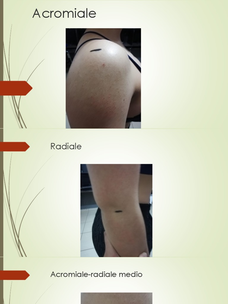 Acromiale | PDF