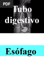 Diverticulos Esofago | PDF | Medicina CLINICA | Especialidades Medicas