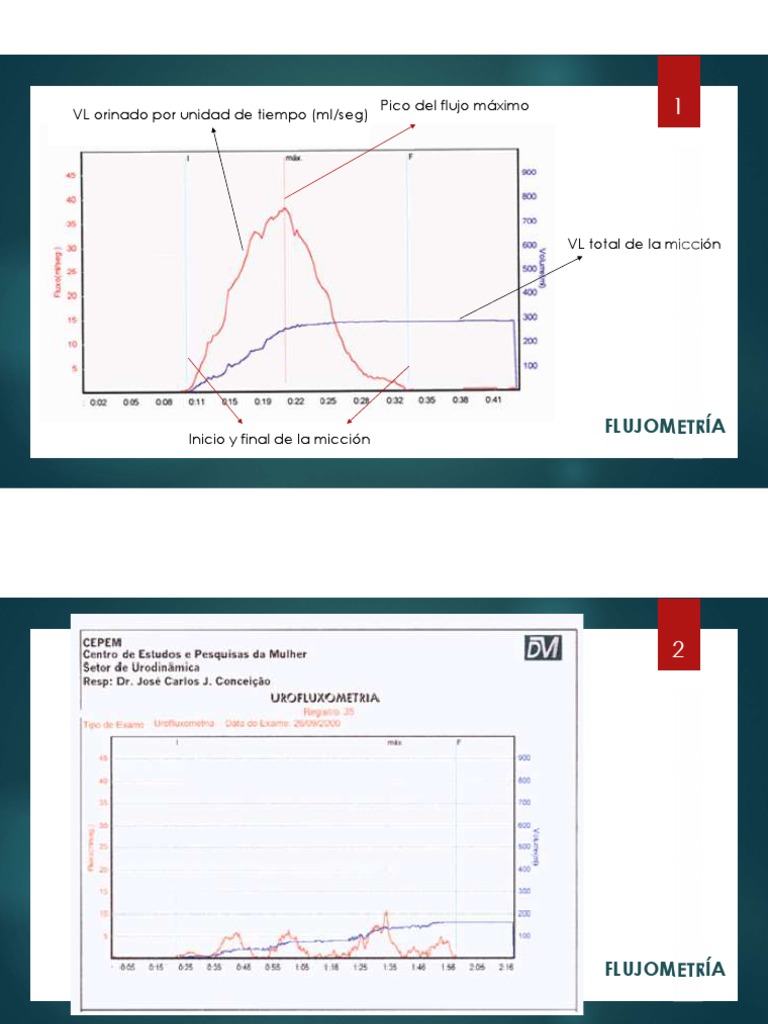 Análisis de la micción mediante flujometría y cistometría: medición del ...
