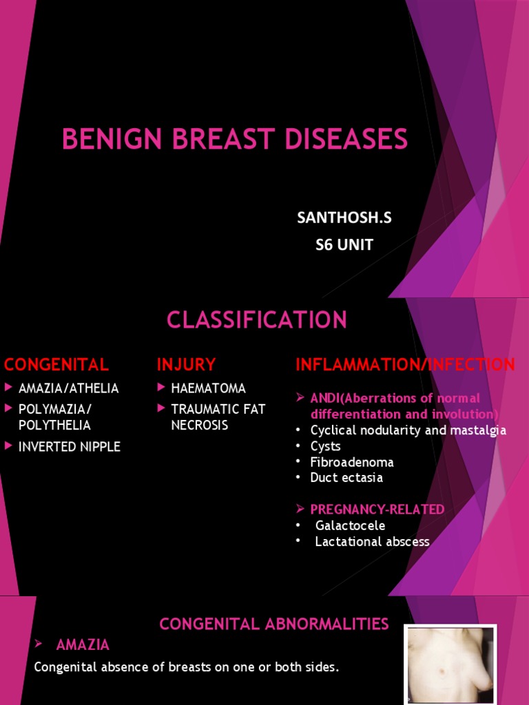 Benign Breast Diseases - Santhosh.S | PDF | Breast Cancer | Health Sciences
