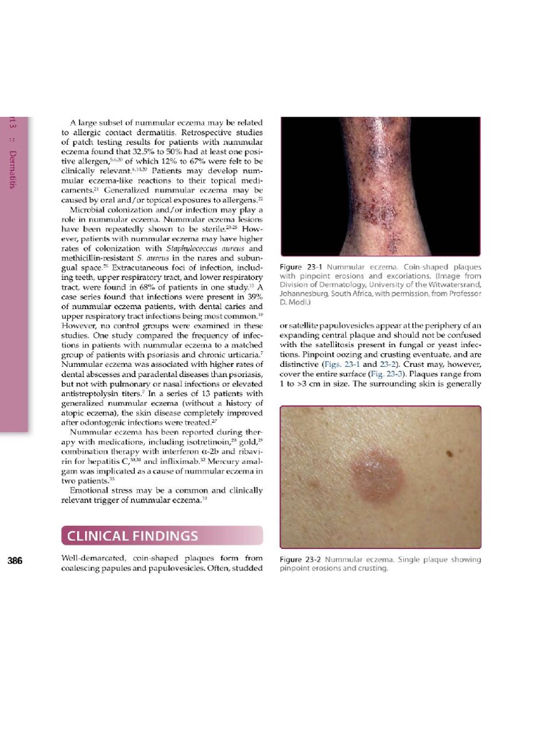 Dermatitis Numularis | PDF