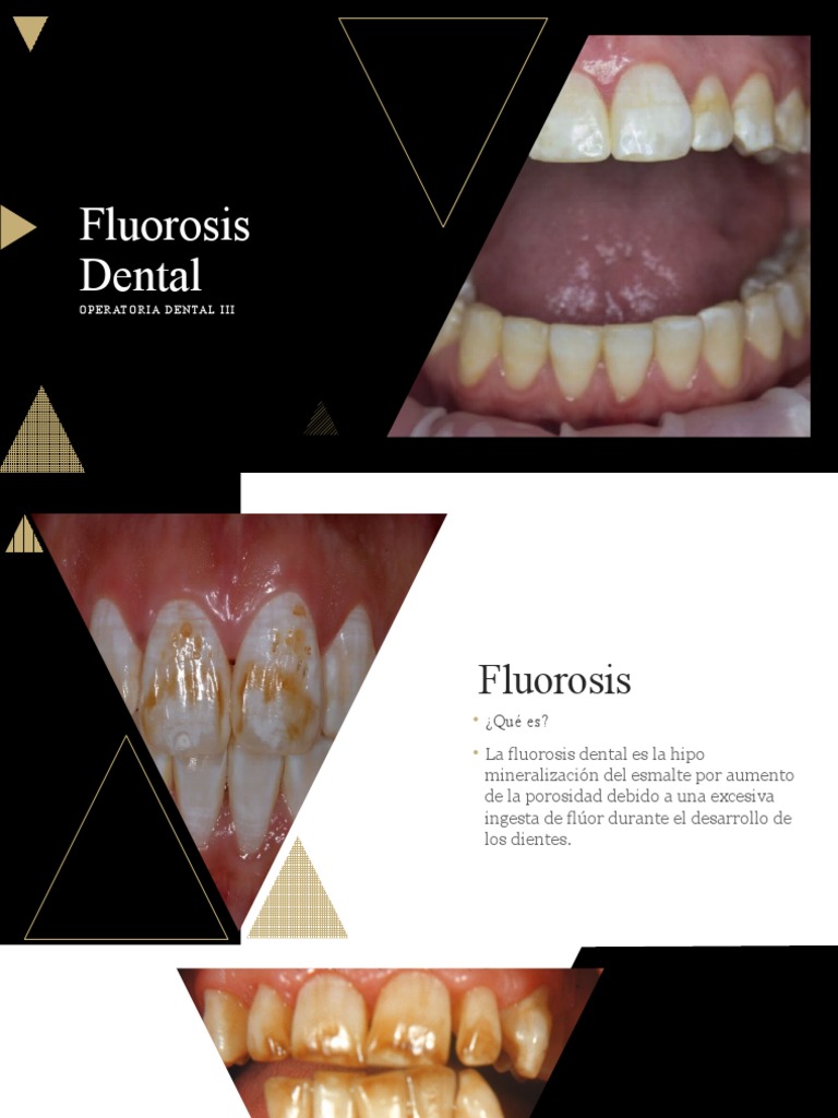 Fluorosis Dental | PDF | Anatomia dental | Especialidades Medicas