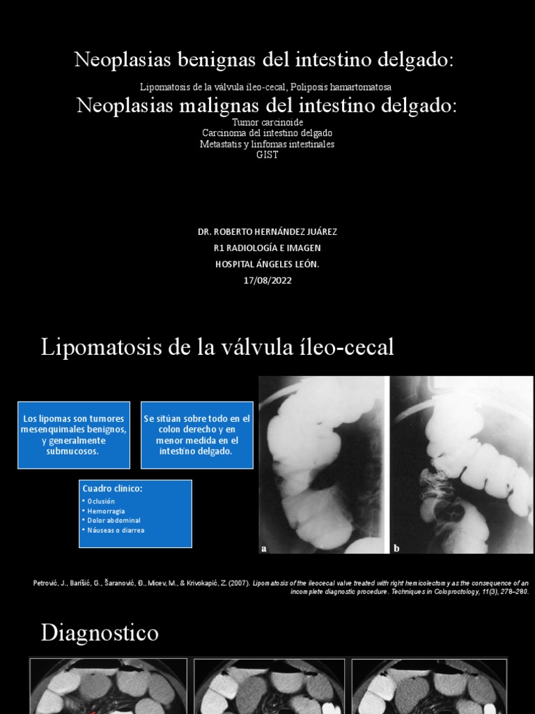Neoplasias del intestino delgado: Características radiológicas de ...