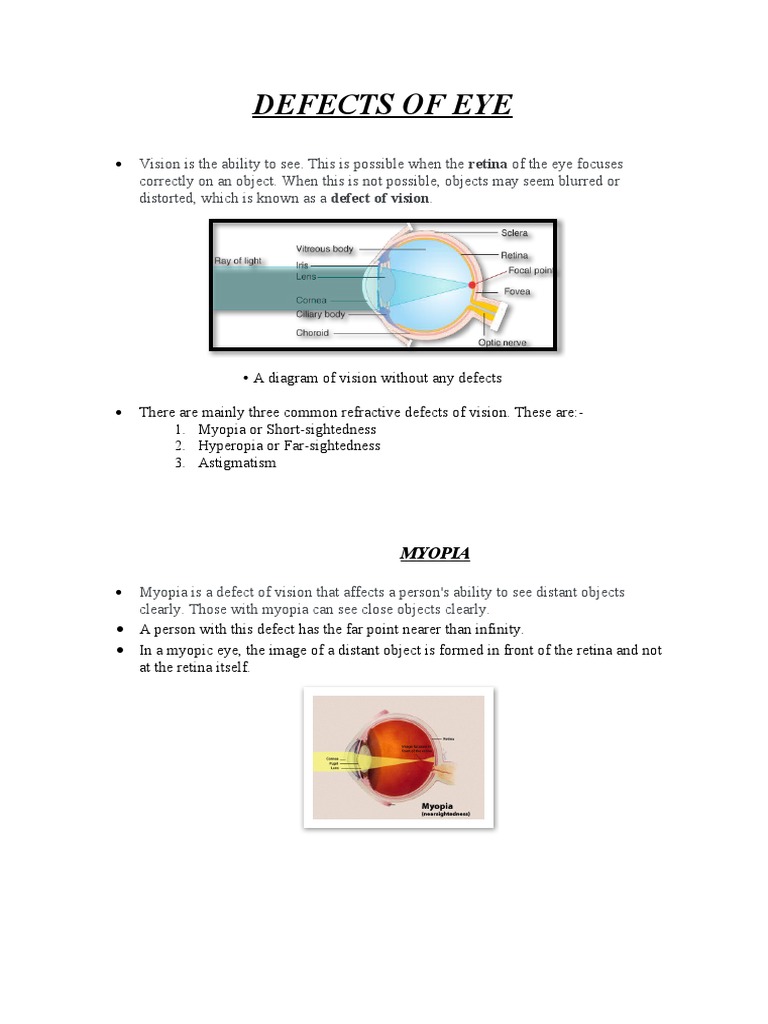 Defects of Eye | PDF | Myopia | Eye