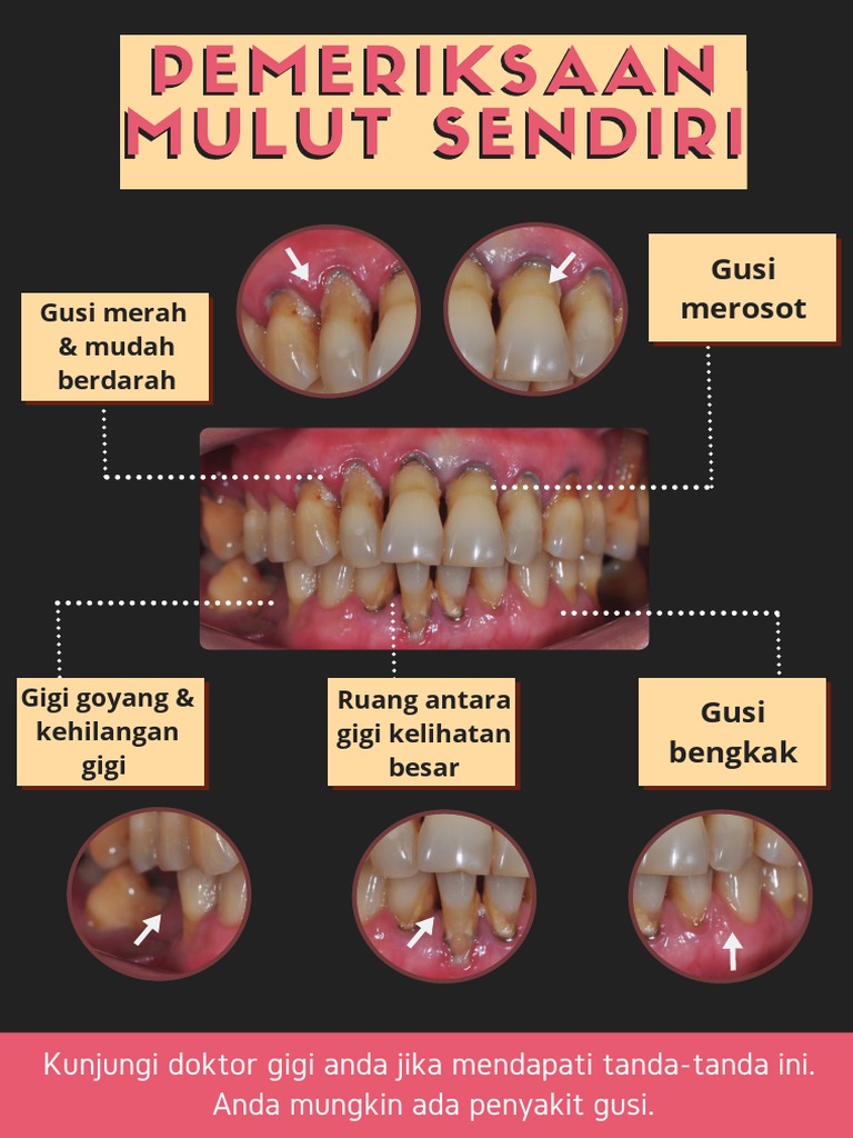 Tanda Penyakit Gusi yang Harus Diwaspadai | PDF