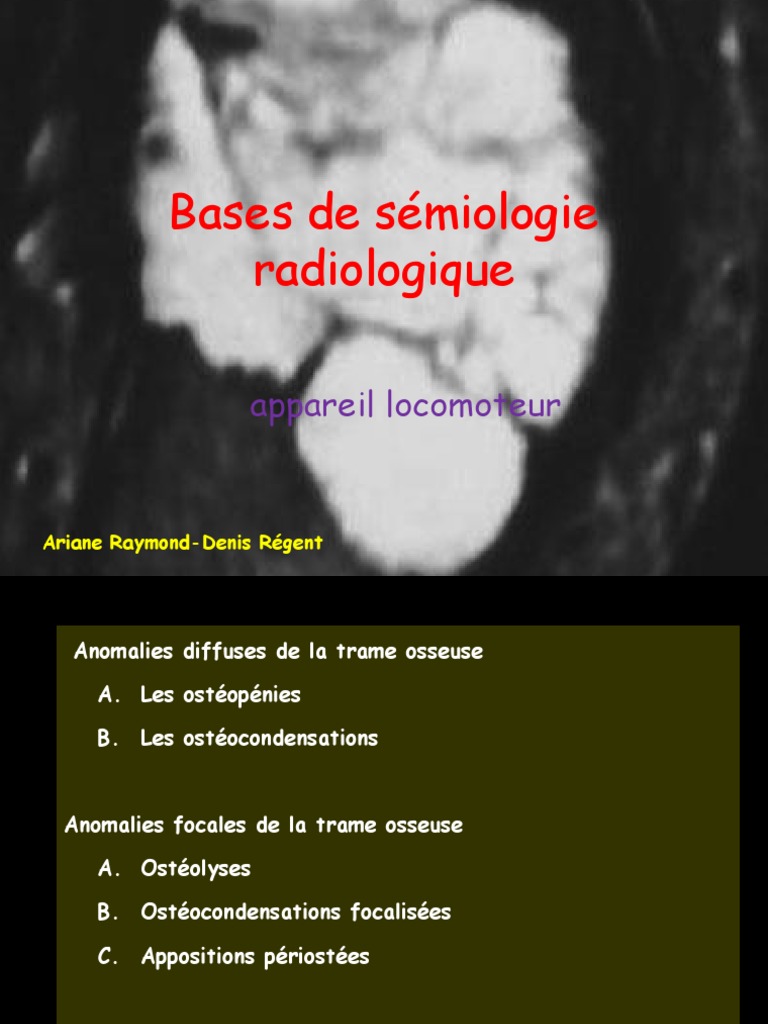 Sémiologie radiologique des os et fractures | PDF | Ostéoporose ...