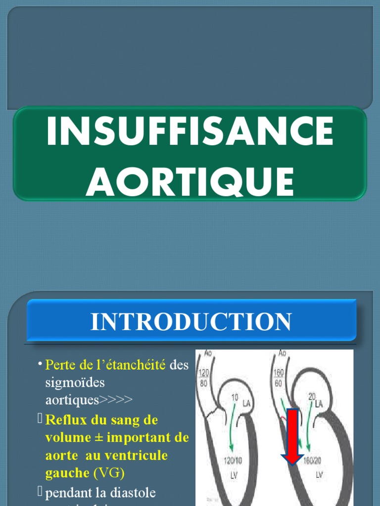 Insuffisance Aortique Short | PDF | Aorte | Maladies et troubles