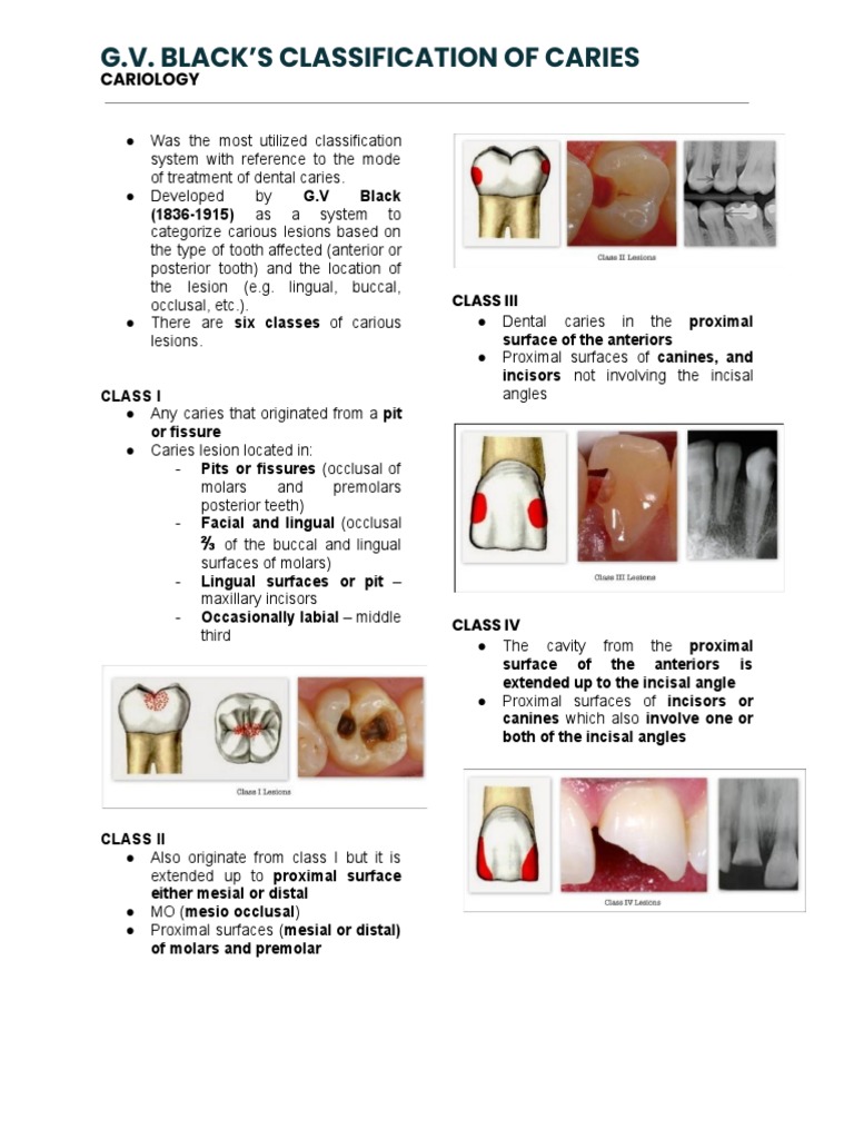 G.V. Blacks Classification of Caries | PDF | Animal Anatomy | Health ...