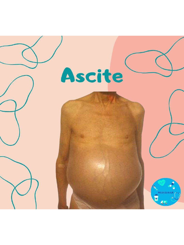 Ascite | PDF