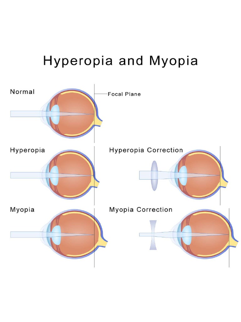 MYOPIA | PDF