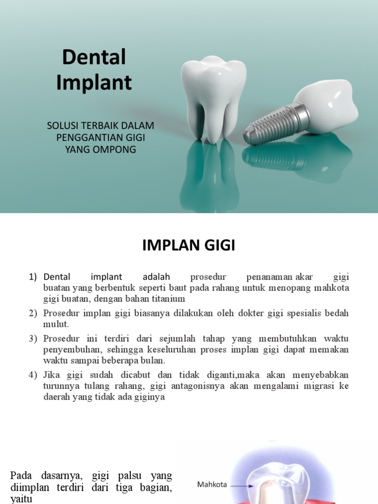Dental Implant | PDF