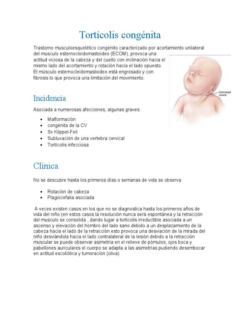 Torticolis Congénita | PDF | Enfermedades y trastornos | Medicina CLINICA