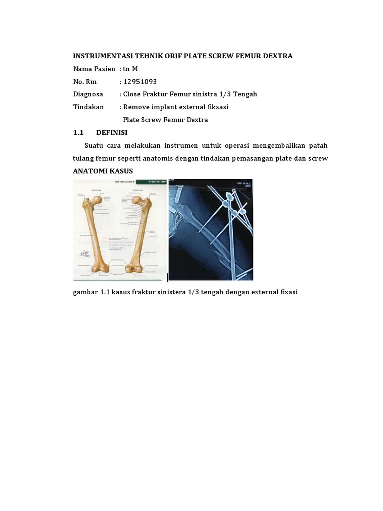 Teknik ORIF Plate Screw Femur Dextra | PDF