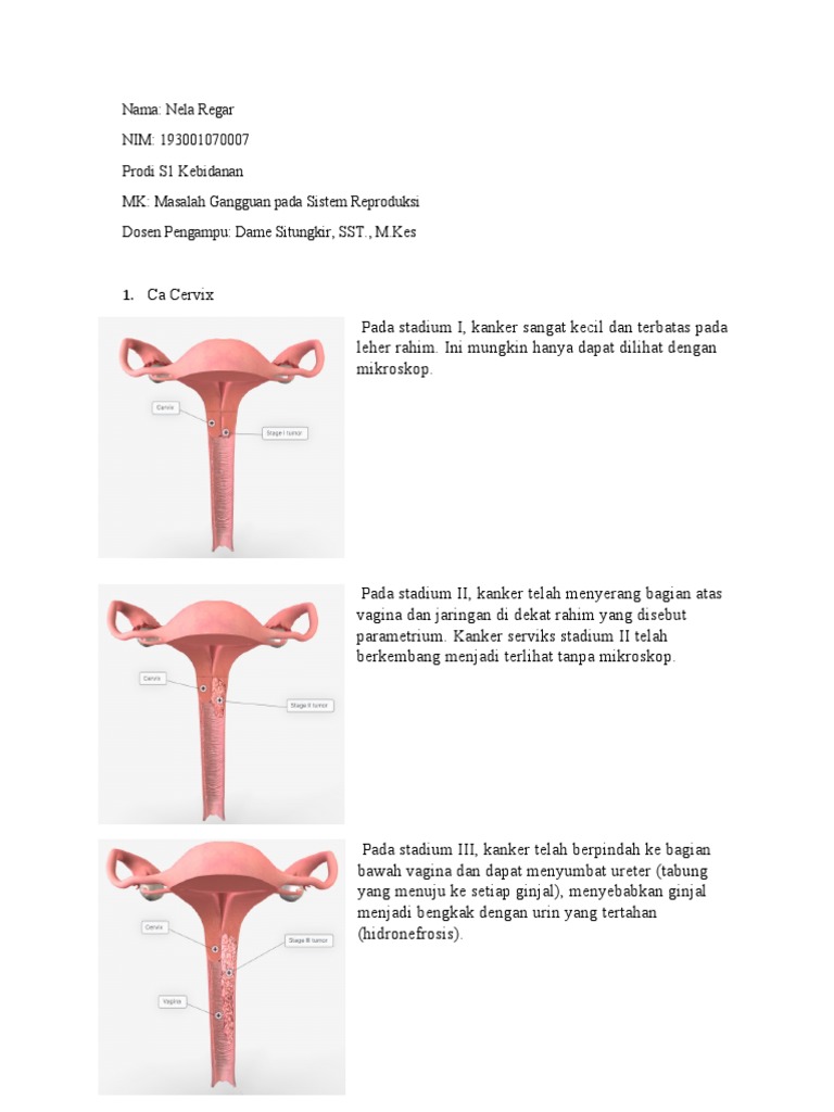 Ca Cervix | PDF