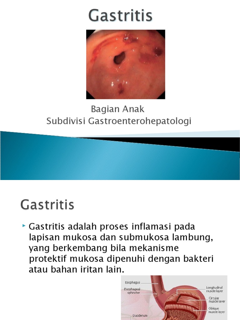 Gastritis PPT | PDF