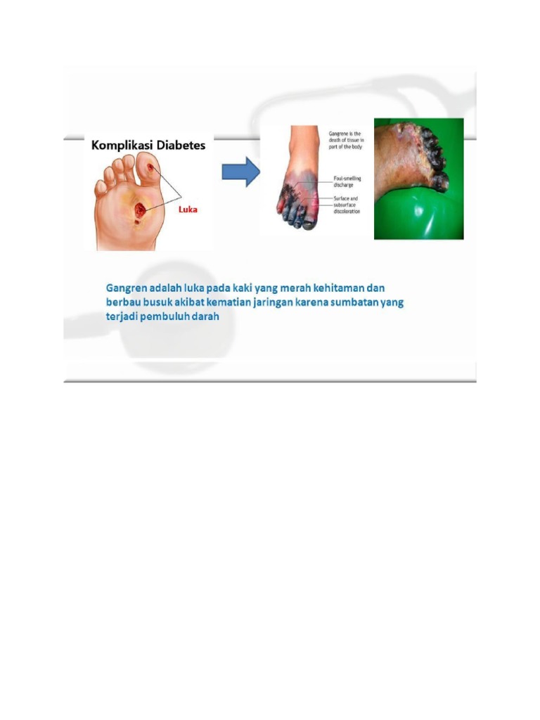 Leaflet Komplikasi DM | PDF